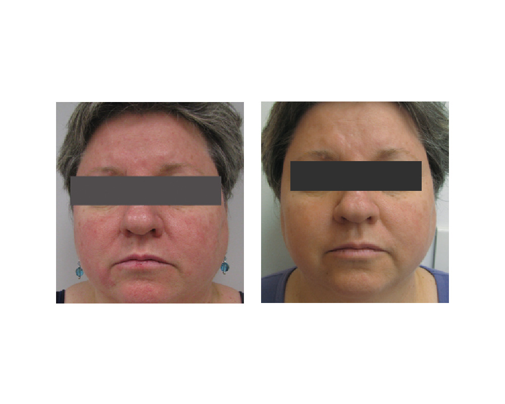 DPC LASER VASCULAR AND PIGMENTED LESIONS – Vertex Aesthetic
